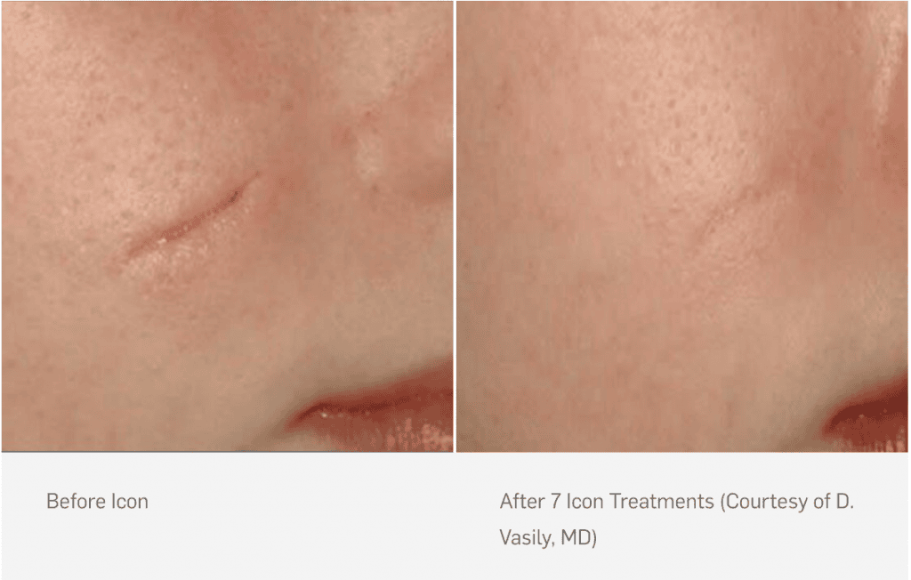 Icon Laser Treatments | Gig Harbor, WA | Nouveau Medspas
